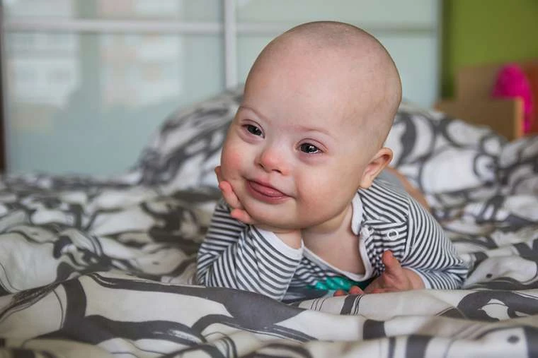 Births of babies with Down syndrome in Europe fall sharply amid ...